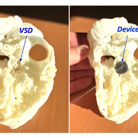 A 3d Printed Model Of Perimembranous Ventricular Septal Defect Vsd