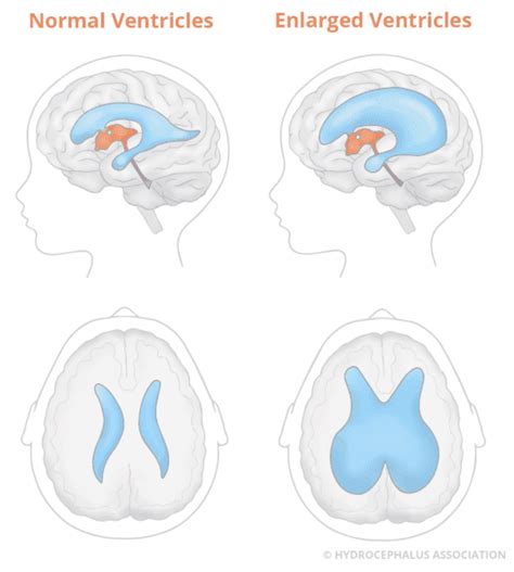 How Cerebrospinal Fluid Works In Hydrocephalus