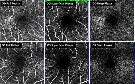 Multimodal Imaging Tells The Tale Of Mac Tel 2 Fluorescene Media