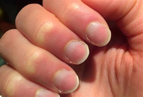 Nail Problems Explained Easy Ways To Spot And Prevent Issues