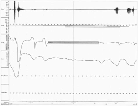 Home Sleep Apnea Monitoring Neupsy Key
