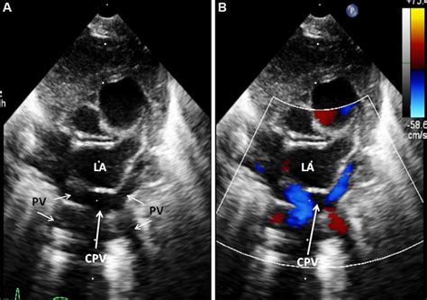 Echocardiography An Overview Part Iii
