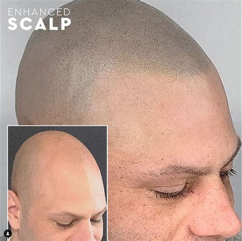 Scalp Micropigmentation Results Gallery Enhanced Scalp Scalp Micropigmentation Results Gallery Enhanced Scalp