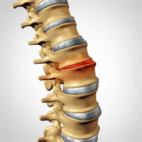 Thinning Spinal Disc Stock Illustration Illustration Of Dorsal 350271821