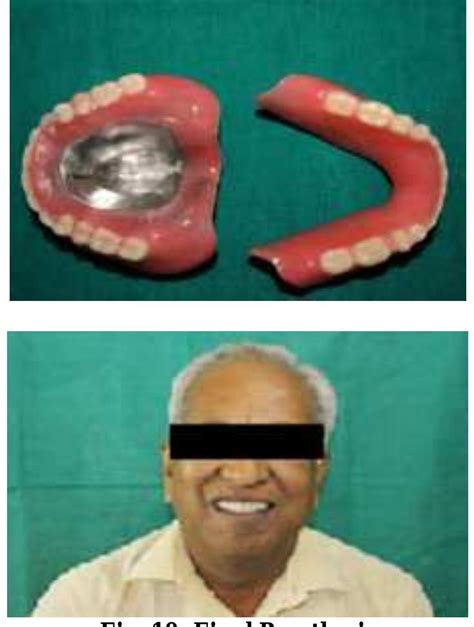 Pdf Conventional Tooth Supported Overdenture With Metal Reinforced