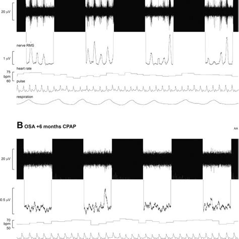 Multiunit Recording Of Muscle Sympathetic Nerve Activity Msna From A Download Scientific
