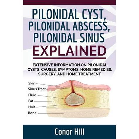 Pilonidal Abscess Home Remedy