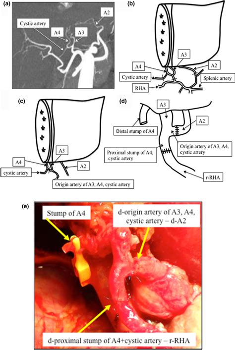 Imagings And Schemas For Case 1 A Three‐dimensional Ct Angiography Of