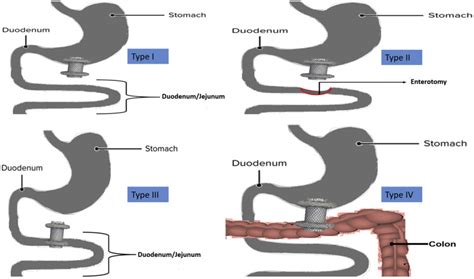 Classification Outcomes And Management Of Misdeployed Stents During