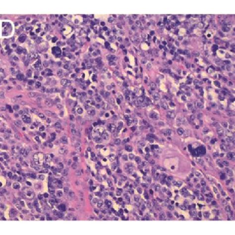 Fish Analysis For Tp53 Deletion Fish Studies Performed On
