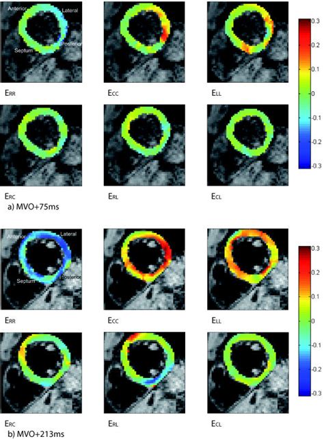 Diastolic Strains All Components Of The Diastolic Lagrangian Strain Download Scientific