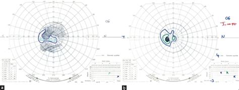 Kinetic Perimetry Of The Left Eye A Before Treatment Generalized