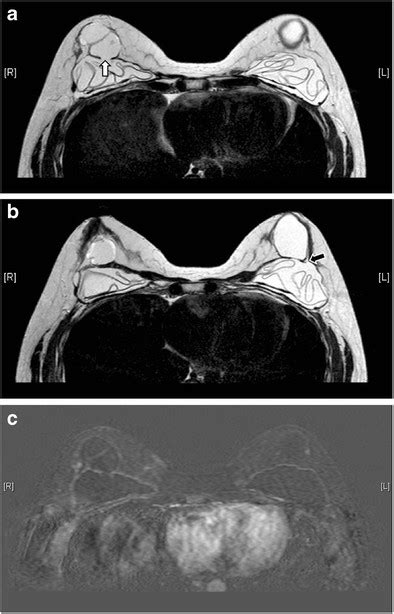 2 Extracapsular Rupture T2 Weighted Axial Mr Images A B Show