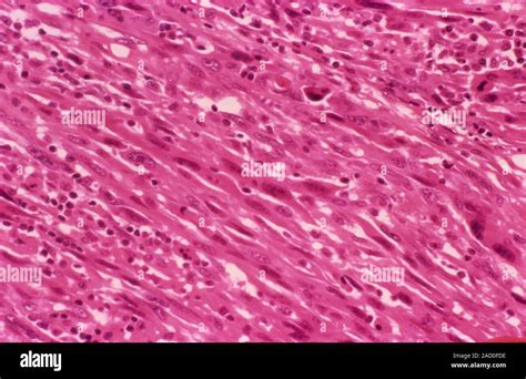 Fibrosarcoma Light Micrograph Of A Section Through A Fibrosarcoma A