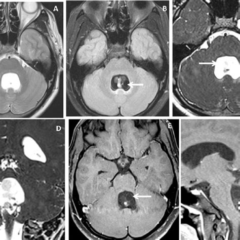 Visibility Score Of Cyst Wall And Scolex Of Intraventricular