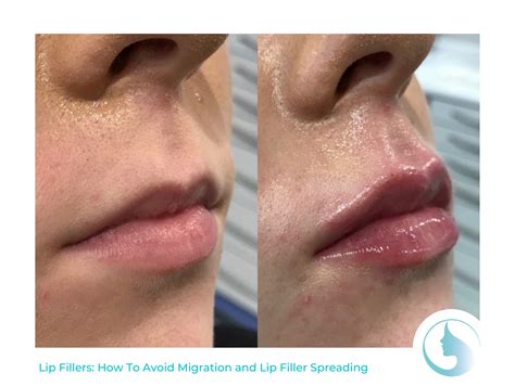 Lip Fillers How To Avoid Migration And Lip Filler Spreading Dr
