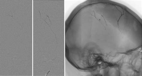 Subdural Hematoma Preventing Recurrence With A Three Step Onyx
