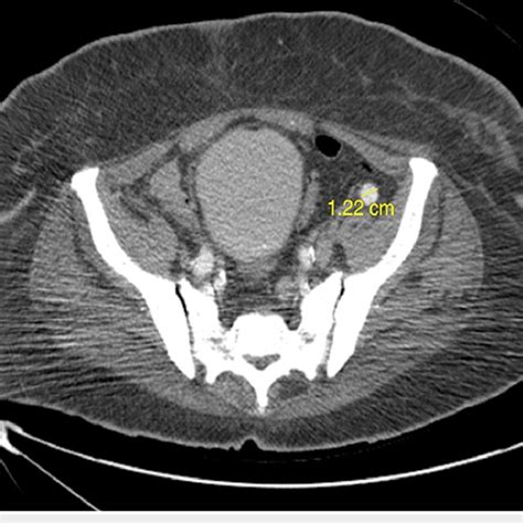 Axial Ct Scan Of The Pelvis Axial Ct Scan Showing Enlarged Right Download Scientific Diagram