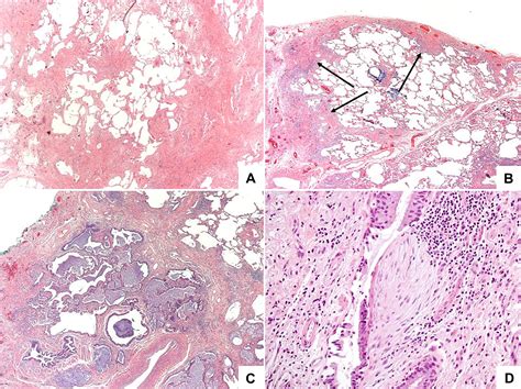 The Role Of Histology In Idiopathic Pulmonary Fibrosis An Update