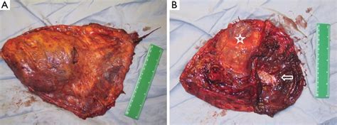 Extrapleural Pneumonectomy Epp Vs Pleurectomy Decortication P D Pmc