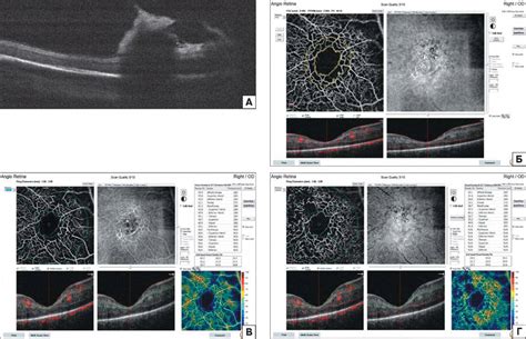 Octa Of Eyes With 3rd Stages Of Active Rop With A Favorable Course Download Scientific Diagram