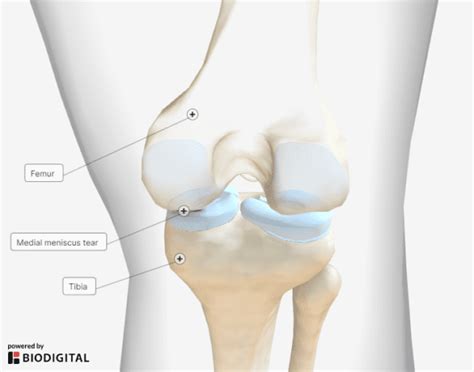 5 Torn Meniscus Exercises To Solve The Root Cause And Ease Pain