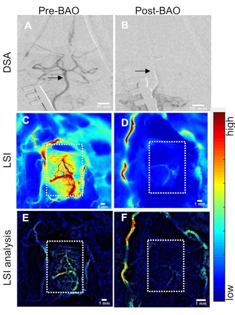 Quantification Of Cerebral Perfusion Using Laser Speckle Imaging And