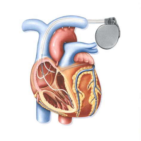 Cardiac Resynchronization Therapy Defibrillator Crt D Asian Heart