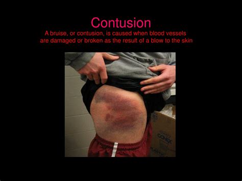 Ppt Comprehensive Guide To Soft Tissue Injuries Powerpoint