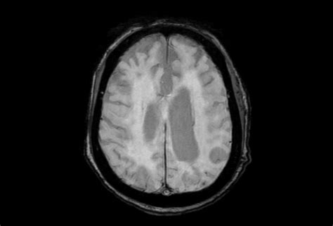Cerebral Amyloid Angiopathy Radiopaedia 86671 102792 Axial Gradient Echo Nc Commons