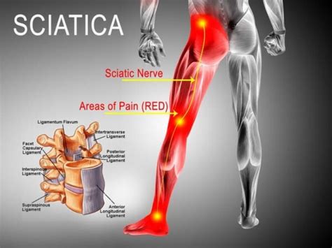 Instant Relief For Sciatic Pain Oc Wellness Physicians