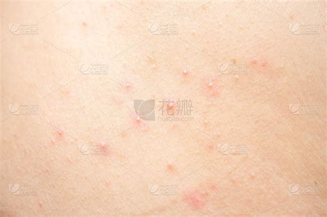 身体上有过敏皮疹。