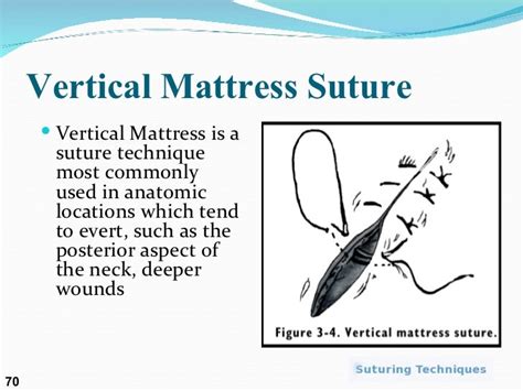 How To Vertical Mattress Suture At Lynda Tawney Blog