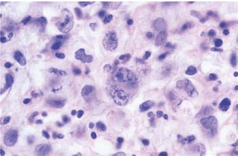 Lymph Node Infarction Basicmedical Key
