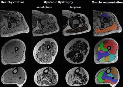 Isokinetic Strength And Degeneration Of Lower Extremity Muscles In