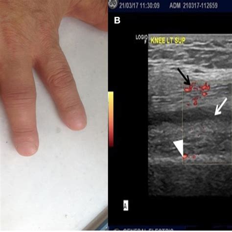 A Arthritis Of Interphalangeal Joints Of The Hands B Ultrasound