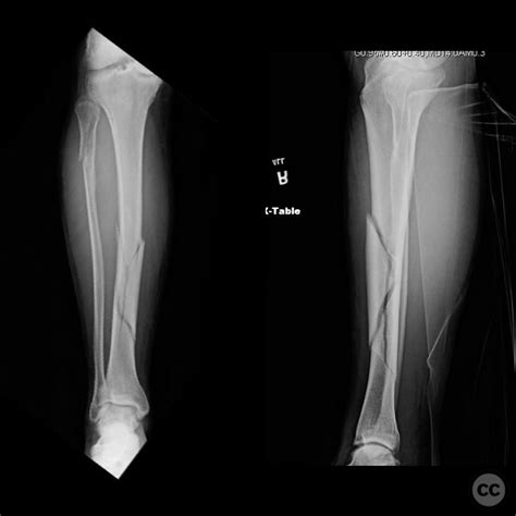 Intramedullary Nailing Of Comminuted Tibial Shaft Fracture With