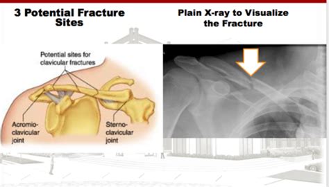 Msk Shoulder And Humerus Flashcards Quizlet