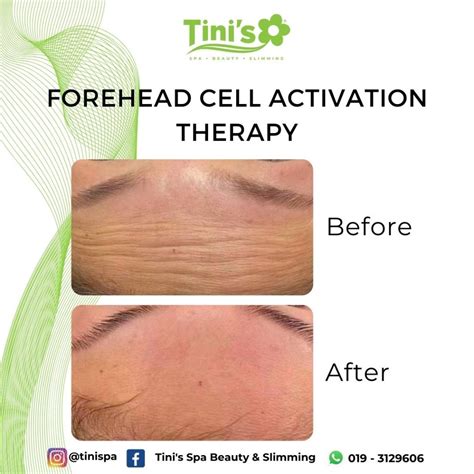 Eye Bag Treatment For Under Eyes Dark Circles Tinis Spa