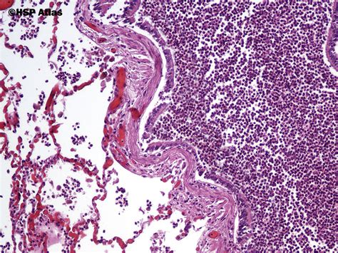 Histology Acute Bronchitis