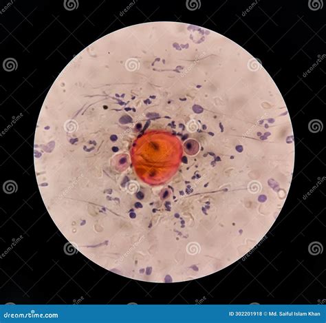 Photomicrograph Of Paps Smear Inflammatory Smear With Vaginal