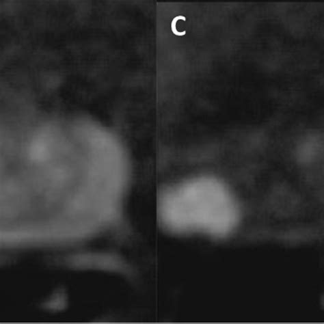 Diffusion Weigthed Images At B Value B0 A B1000 B B2000 C And