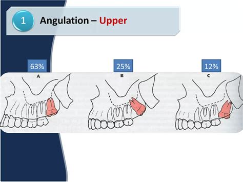 Complicated Extraction And Odontectomy Ppt