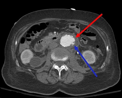 Computed Tomography Angiography Cta Axial View Demonstrating Aortic