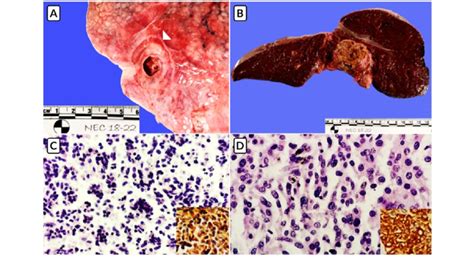 Carcinoma Dobre Primario En Autopsia A Nódulo Pulmonar Punta De