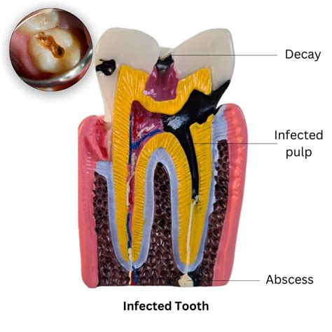 Tooth Infection Treatment Shalman Dentistry In Lower Manhattan Ny