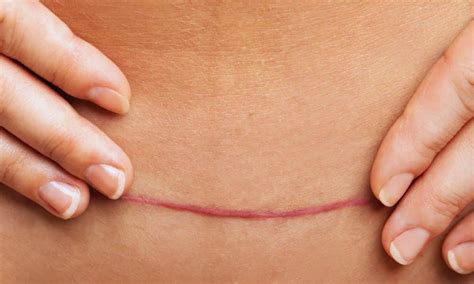 What Causes Hypertrophic Scars And How Can They Be Treated