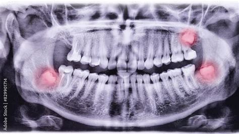 Wisdom Teeth Removal Red Flashing Indicators For Misaligned Growth Of Wisdom Teeth In A Small