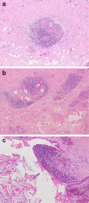 Case 11 This Thyroid Contained Solid Cell Nests Associated With