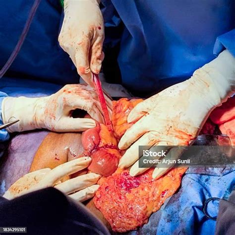Doctors Doing Exploratory Laparotomy Surgery In A Patient With